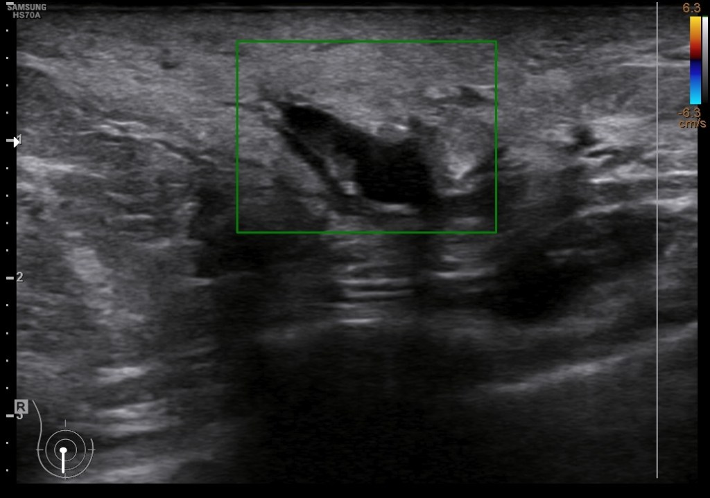 252. Mastitis. – Ecografía Fácil