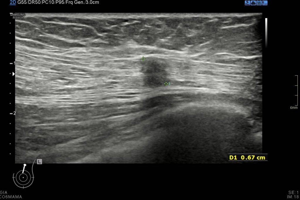 259. Mastectomía bilateral. Lesión pectoral. – Ecografía Fácil