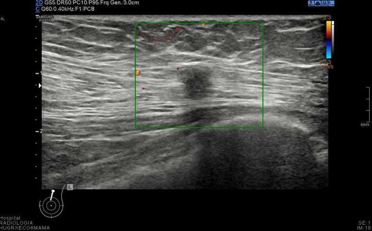 259. Mastectomía bilateral. Lesión pectoral. – Ecografía Fácil
