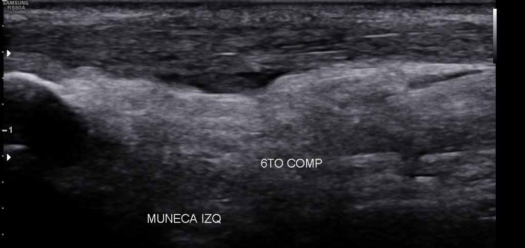 270. El Sexto Compartimento. – Ecografía Fácil