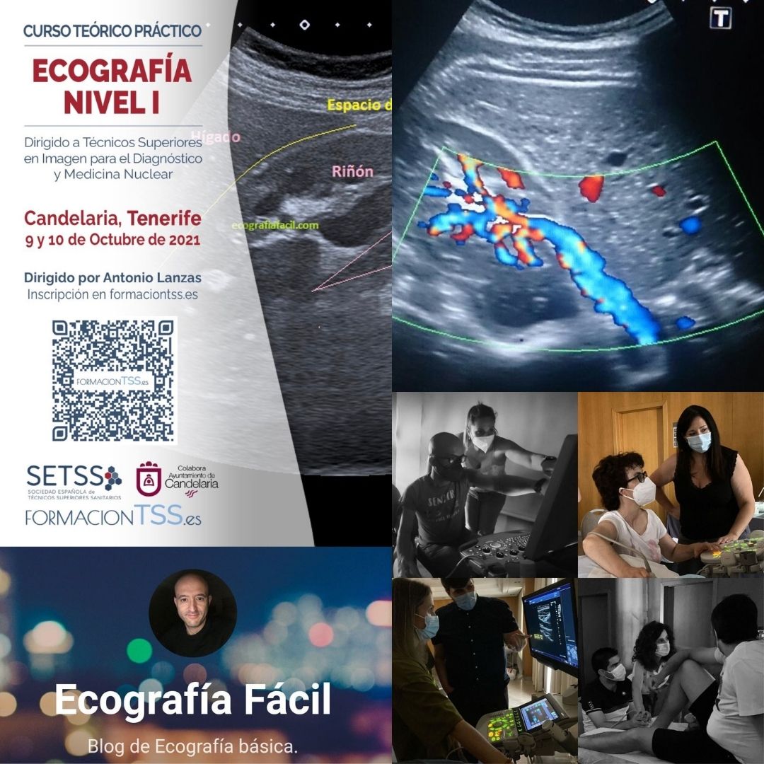 262. Quiste Hidatídico Calcificado.Clasificación de Gharbi. – Ecografía ...