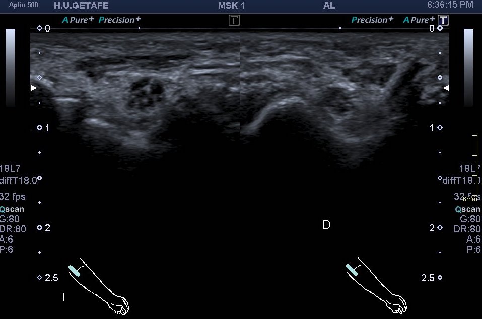 Ancóneo Epitroclear – Ecografía Fácil