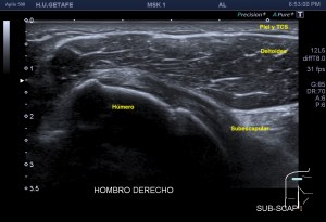 290. Rotura del Subescapular. – Ecografía Fácil