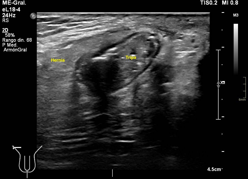 291. Lipoma de cordón y hernia inguinal. – Ecografía Fácil