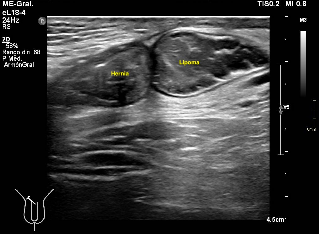291. Lipoma de cordón y hernia inguinal. – Ecografía Fácil