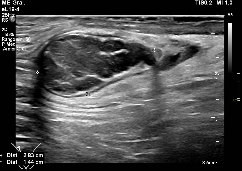 291. Lipoma de cordón y hernia inguinal. – Ecografía Fácil