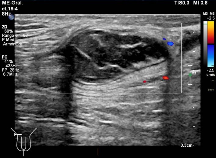 291. Lipoma de cordón y hernia inguinal. – Ecografía Fácil