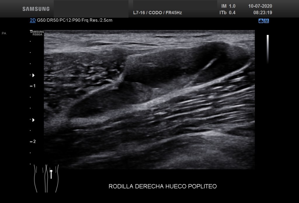 285. Quiste de Baker. – Ecografía Fácil