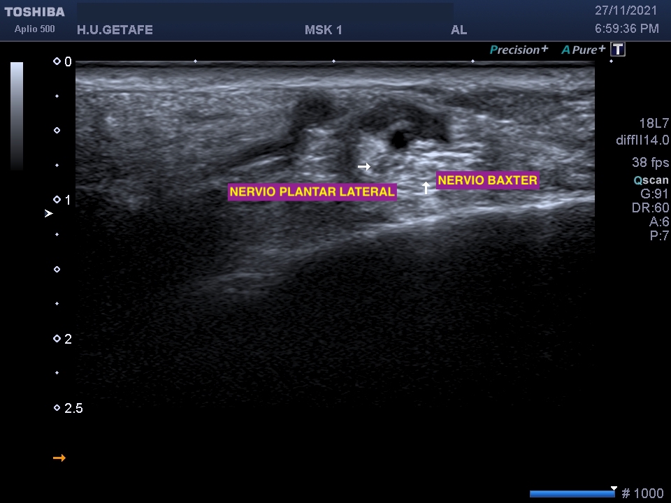 297. Nervio Tibial Posterior y Nervio Baxter – Ecografía Fácil