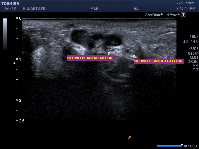 297. Nervio Tibial Posterior y Nervio Baxter – Ecografía Fácil