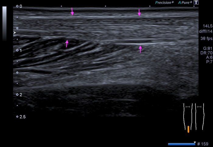 317. El tendón. Tipos y patología. – Ecografía Fácil