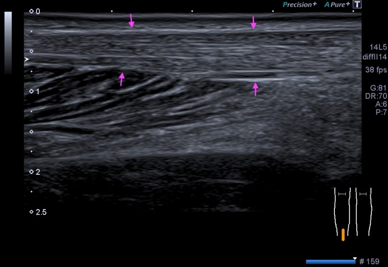 317. El tendón. Tipos y patología. – Ecografía Fácil