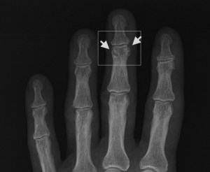 318. Nódulos de Heberden y Bouchard. – Ecografía Fácil