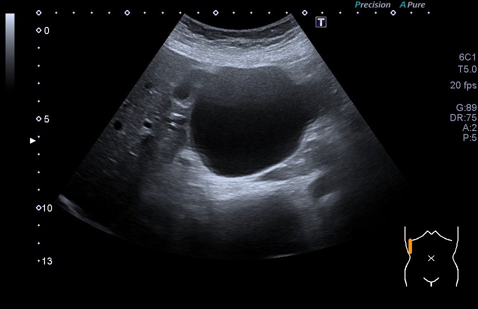315. Clasificación Bosniak – Ecografía Fácil