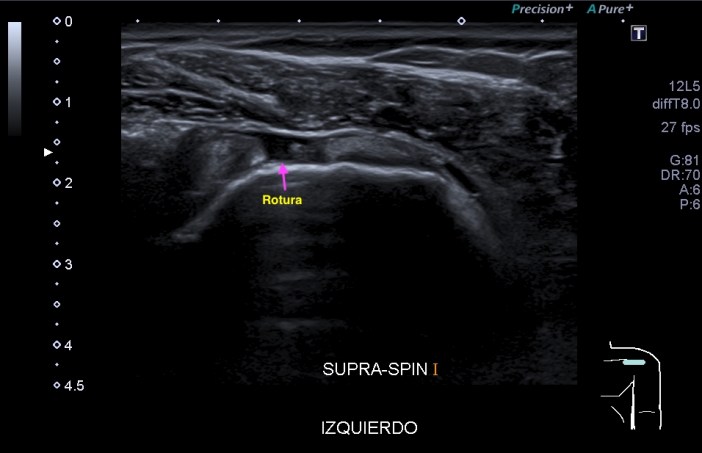 317. El tendón. Tipos y patología. – Ecografía Fácil
