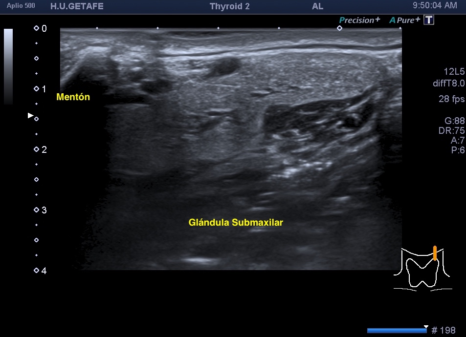 326. Las glándulas salivares. – Ecografía Fácil