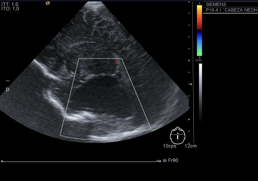 Quiste Aracnoideo – Ecografía Fácil