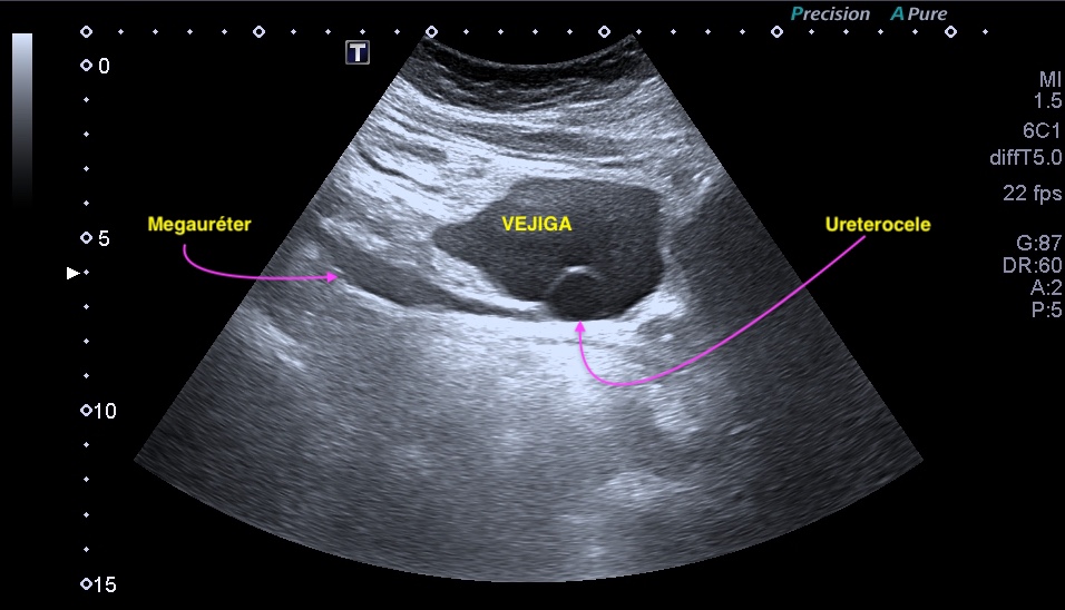 335. Ureterocele bilateral por ecografía, un hallazgo poco frecuente ...