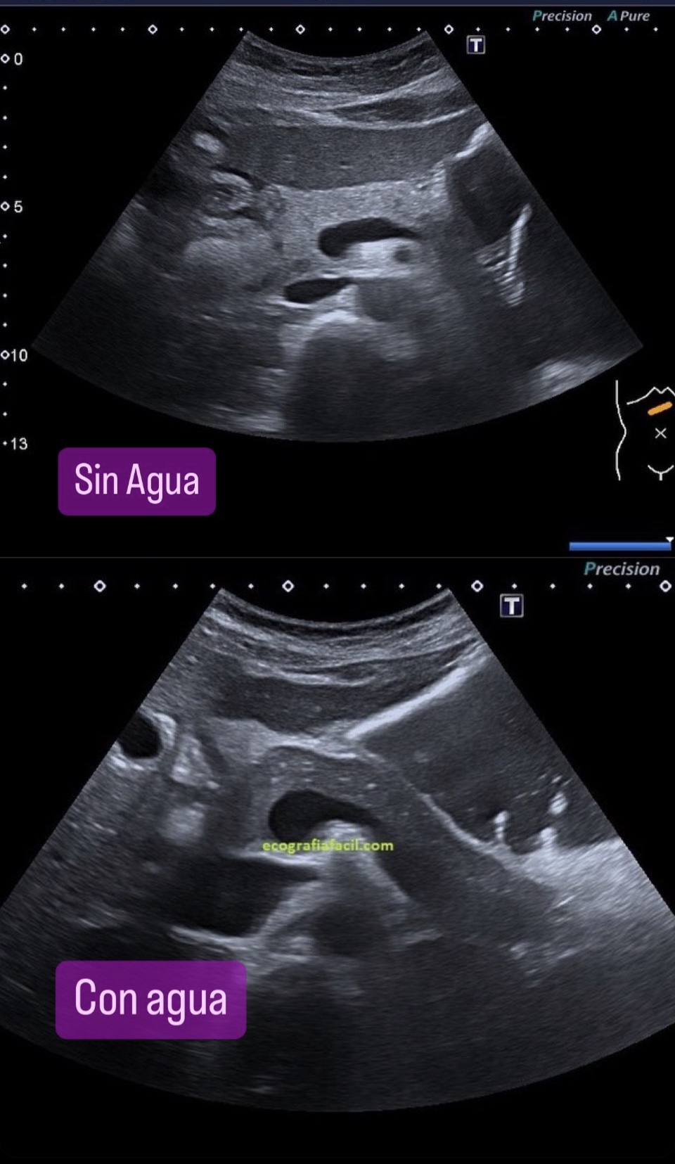 334.Páncreas. Revisión y Tip. – Ecografía Fácil