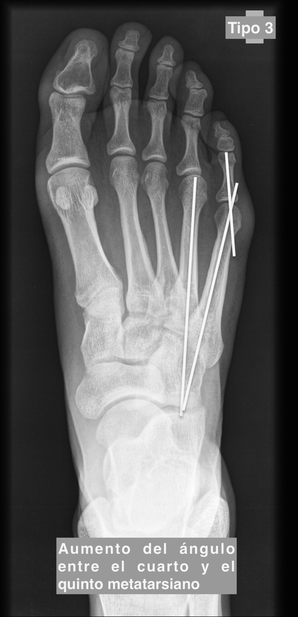 332. El Juanete del Sastre o Quintus Varus. – Ecografía Fácil