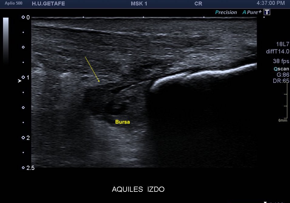 340. Bursitis retroaquilea. – Ecografía Fácil