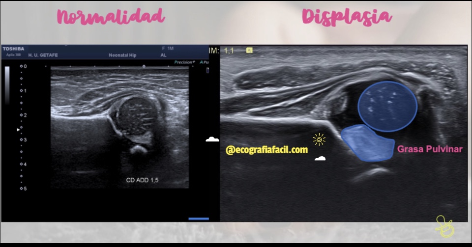 341 La Cadera Neonatal Conceptos E Imágenes Clave Tips Ecografía