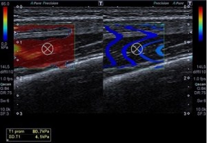 344. Lo que el 2D y el Doppler no ve… – Ecografía Fácil