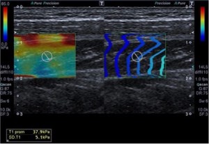 344. Lo que el 2D y el Doppler no ve… – Ecografía Fácil