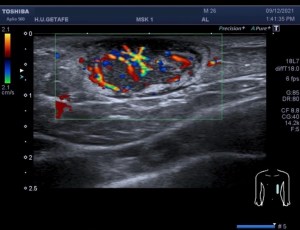 348. Doppler. Tipos y técnicas. – Ecografía Fácil