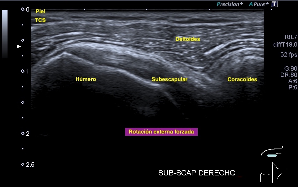 Título: Anatomía, Función y Aspecto Ecográfico del Tendón del ...
