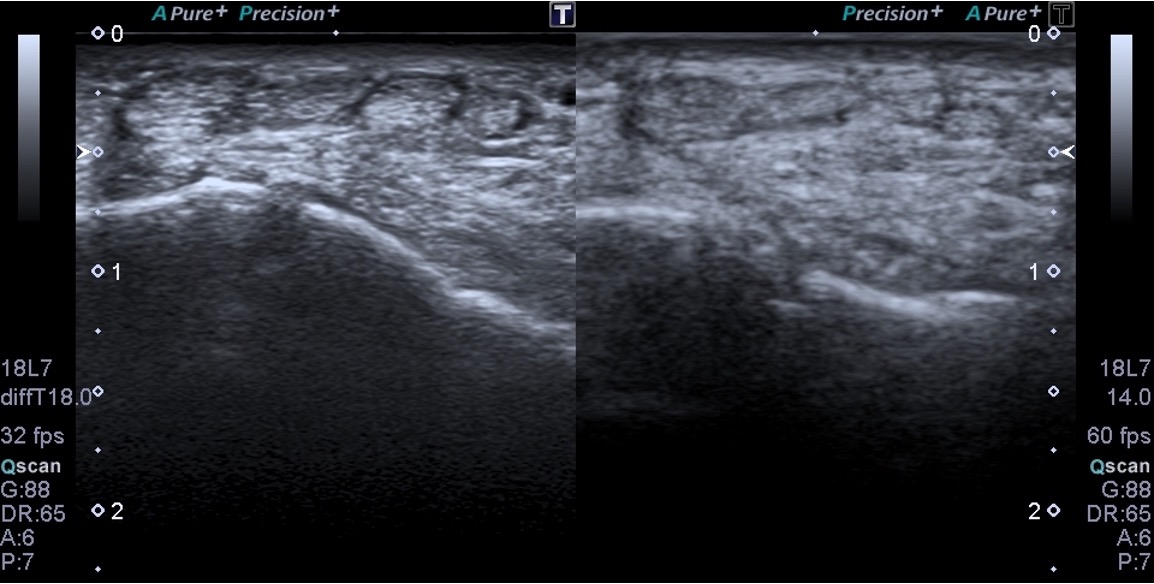 363. El Moteado Aleatorio en la imagen de Ecografía.Uso de Armónicos y ...