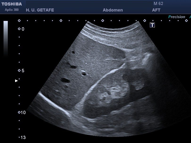 362. La Fibrosis Hepática en Ecografía. Datos clave para el TSID ...