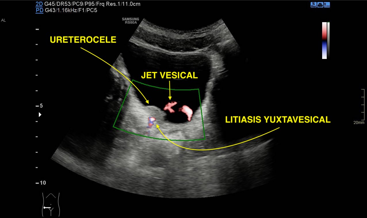 381. Ureterocele y Litiasis Yuxtavesical infantil en el contexto de ...