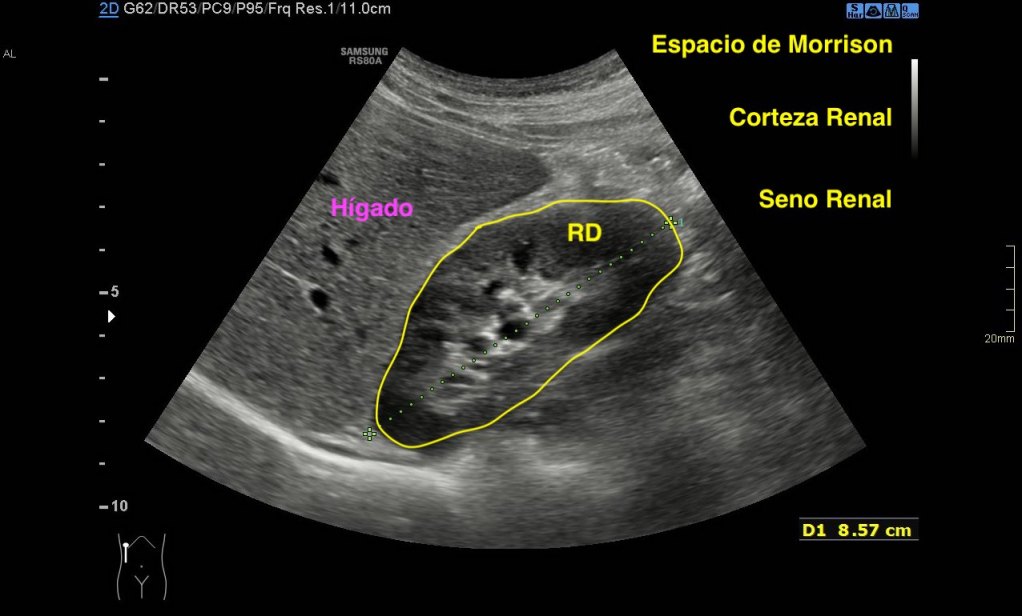381. Ureterocele y Litiasis Yuxtavesical infantil en el contexto de ...
