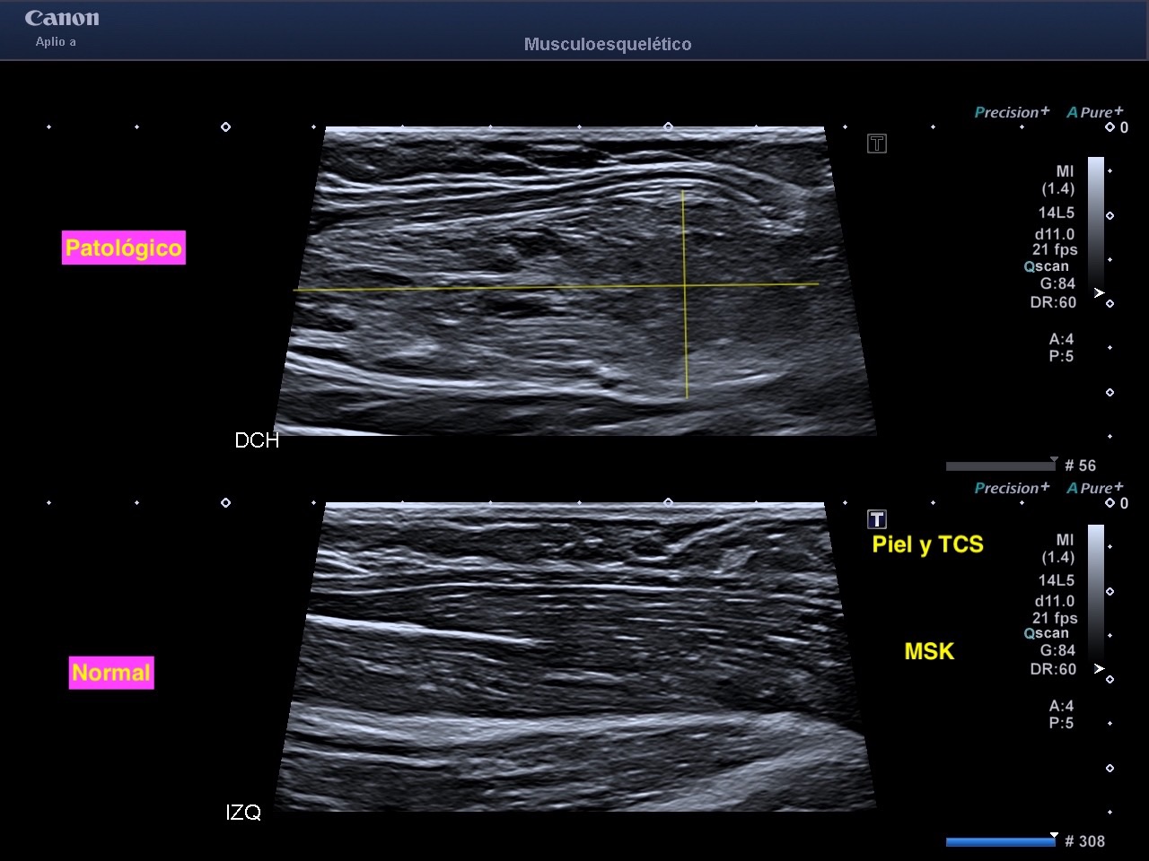 388. El Lipoma Intramuscular. – Ecografía Fácil