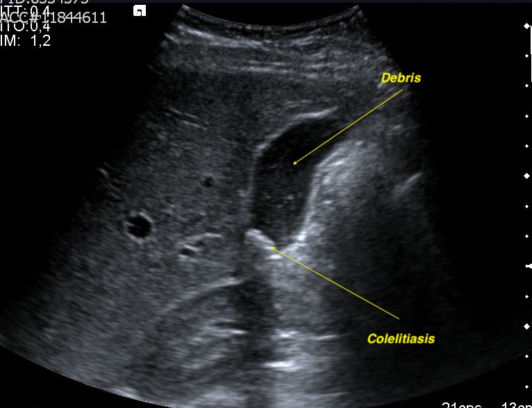 405. El Debris Ecográfico – Ecografía Fácil