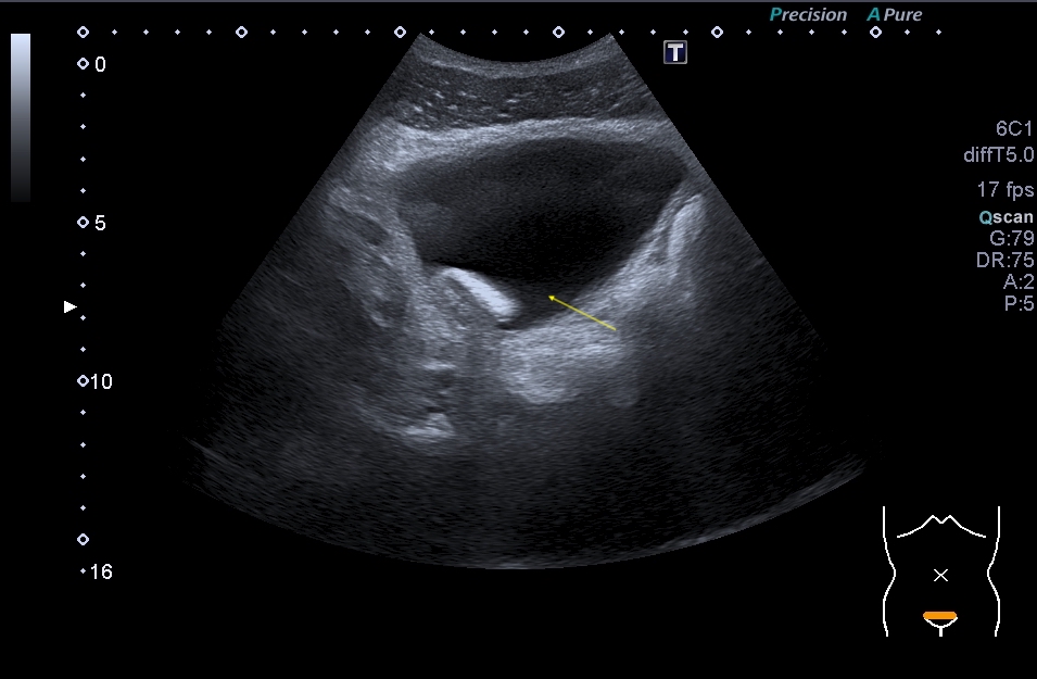 405. El Debris Ecográfico – Ecografía Fácil