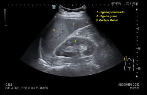 409. Semiología Ecográfica del Hígado Preservado y Hígado Graso ...