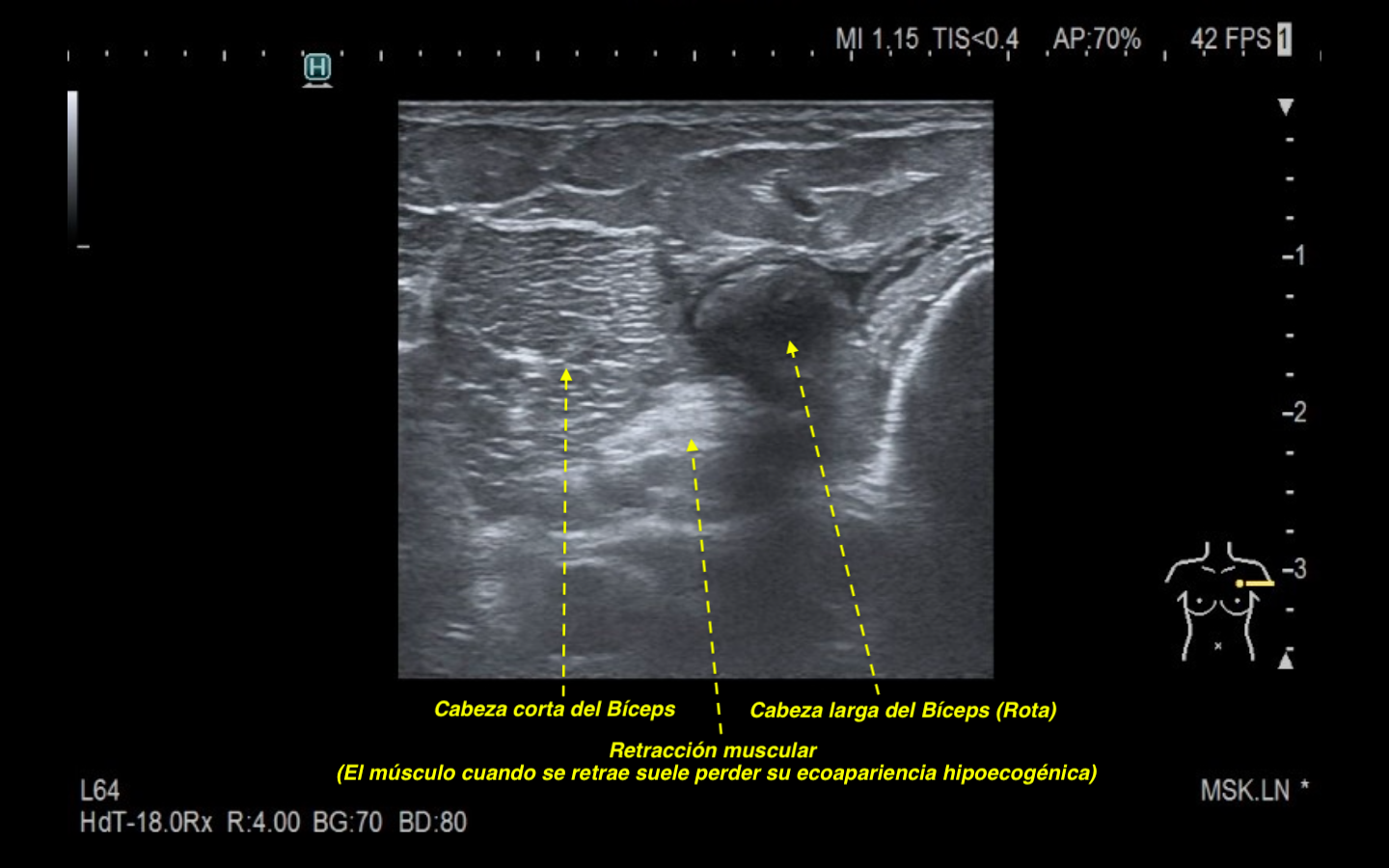 406. El Gap y el Signo de Popeye – Ecografía Fácil