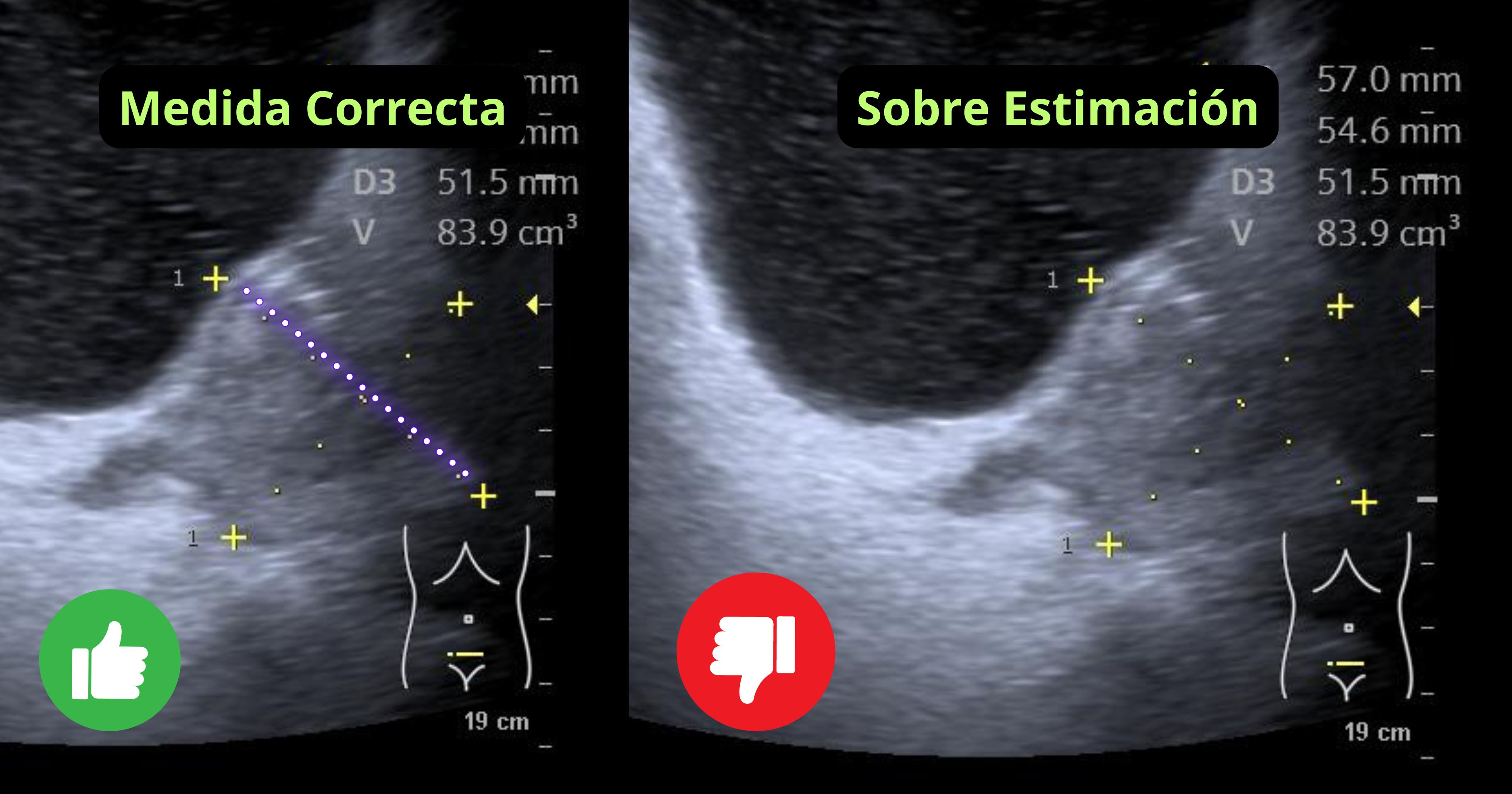 420. HBP – Medidas y Clasificación – Ecografía Fácil