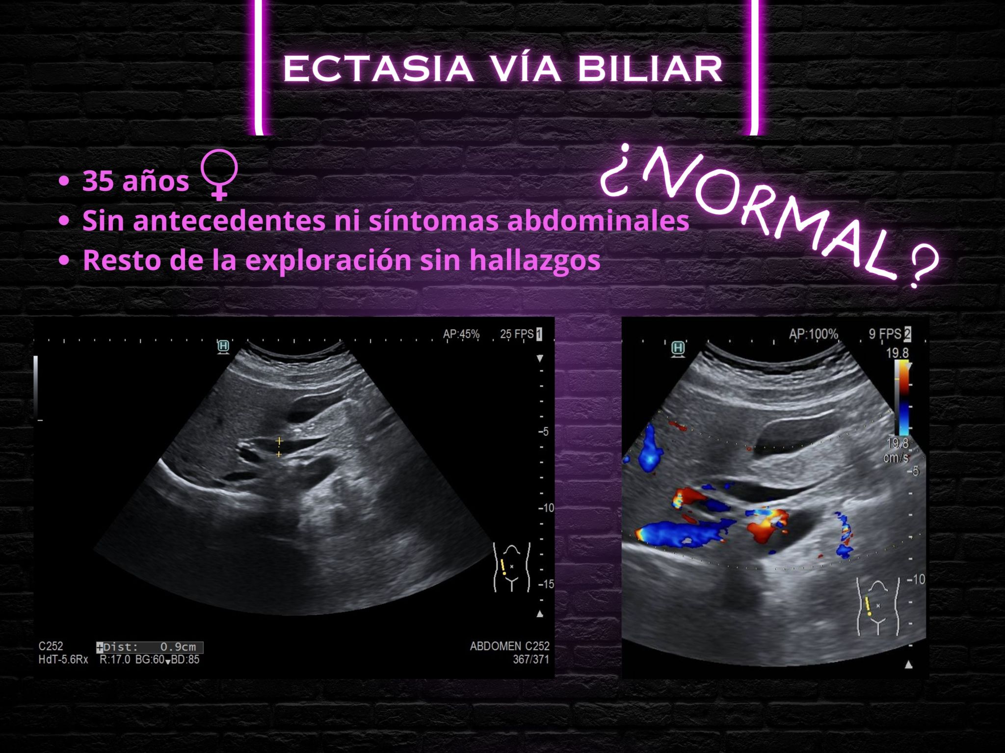 424. Dilatación de la vía biliar, clasificación y la correlación ...