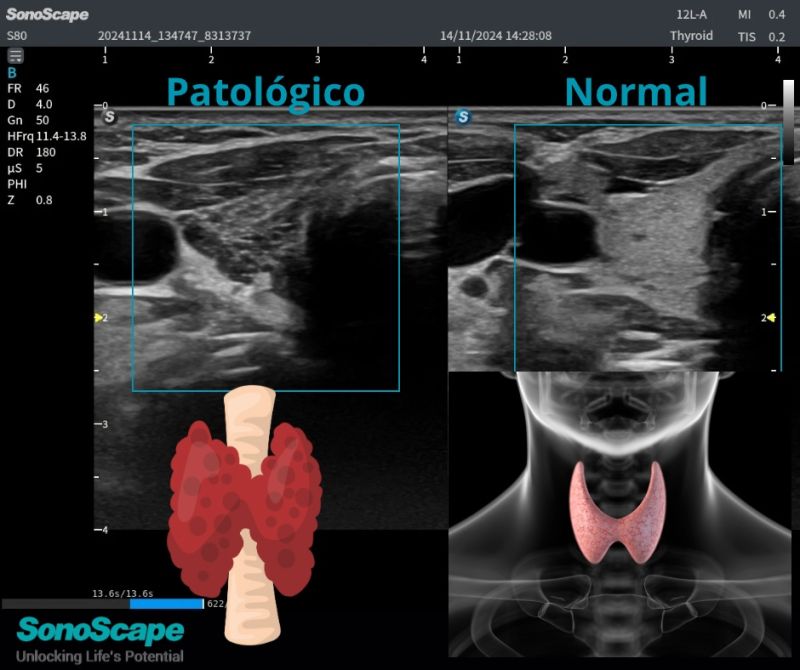 430. Ecografía de la Glándula Tiroidea: Normalidad y Patología ...