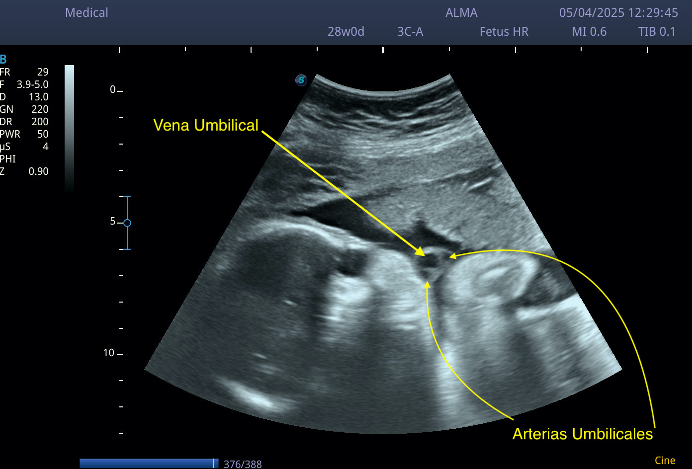 433. El Cordón Umbilical – Ecografía Fácil