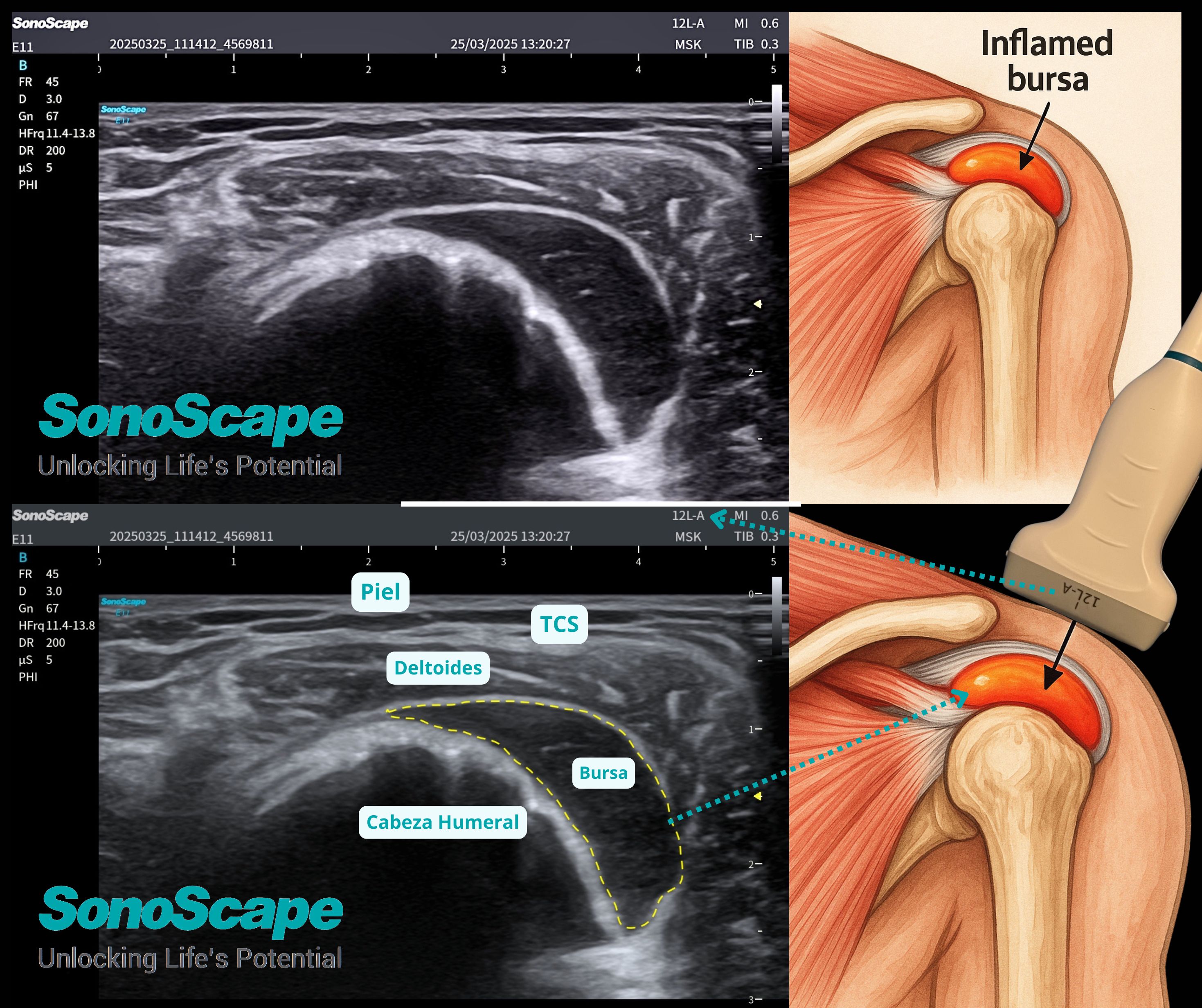 434 Bursitis del Hombro – Ecografía Fácil