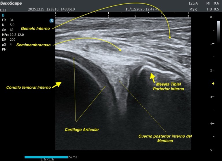 457. Ecoanatomía del menisco medial posterior de la rodilla – Ecografía ...